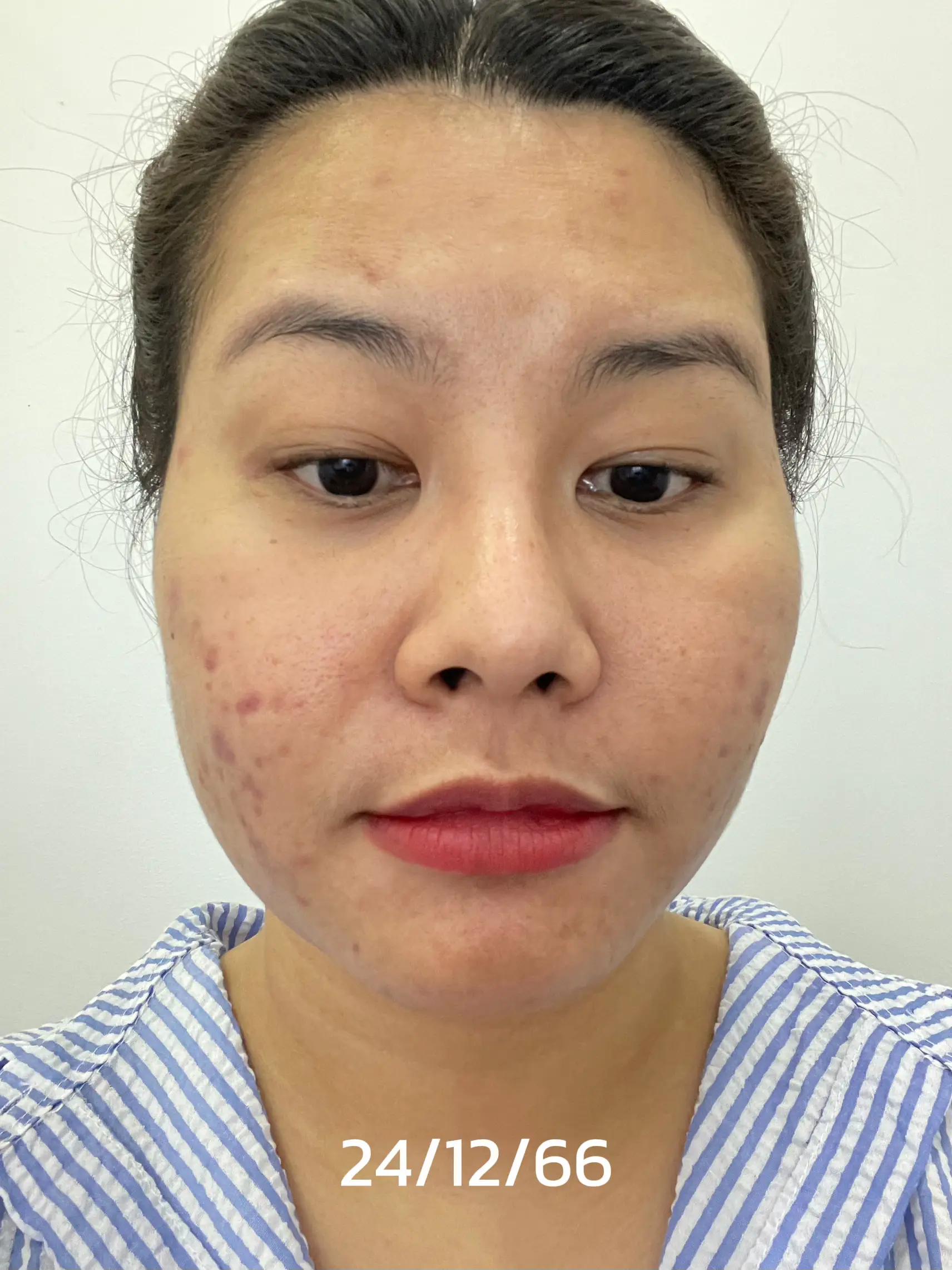 Ep.1. รักษาสิวครั้งแรก @พรเกษมคลีนิค | แกลเลอรีที่โพสต์โดย Mm.mee NRKL | Lemon8