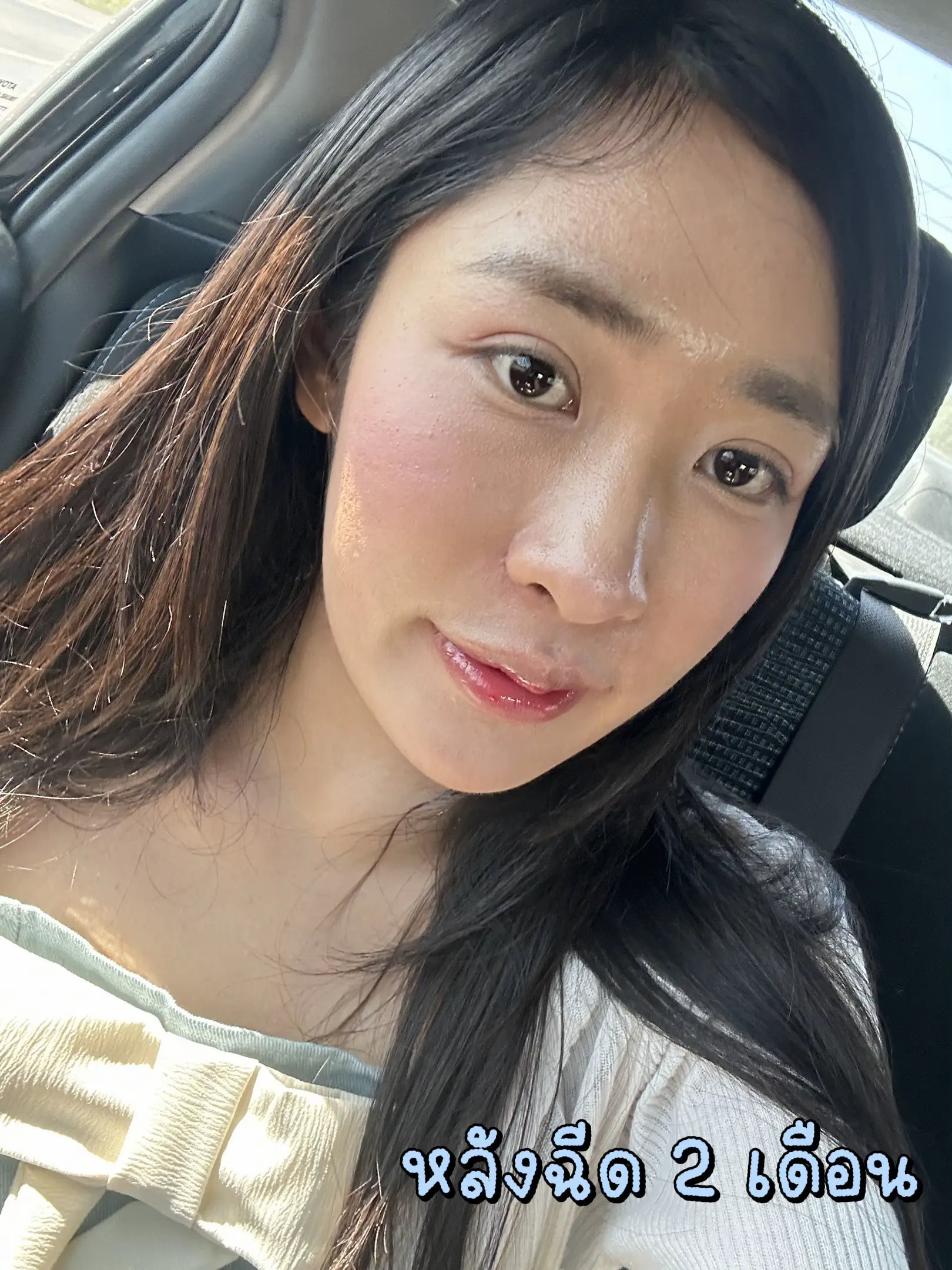 รีวิวประสบการณ์ฉีดหน้าที่เกาหลี💉🇰🇷 | แกลเลอรีที่โพสต์โดย fahsai ⋆𐙚₊˚⊹♡ | Lemon8