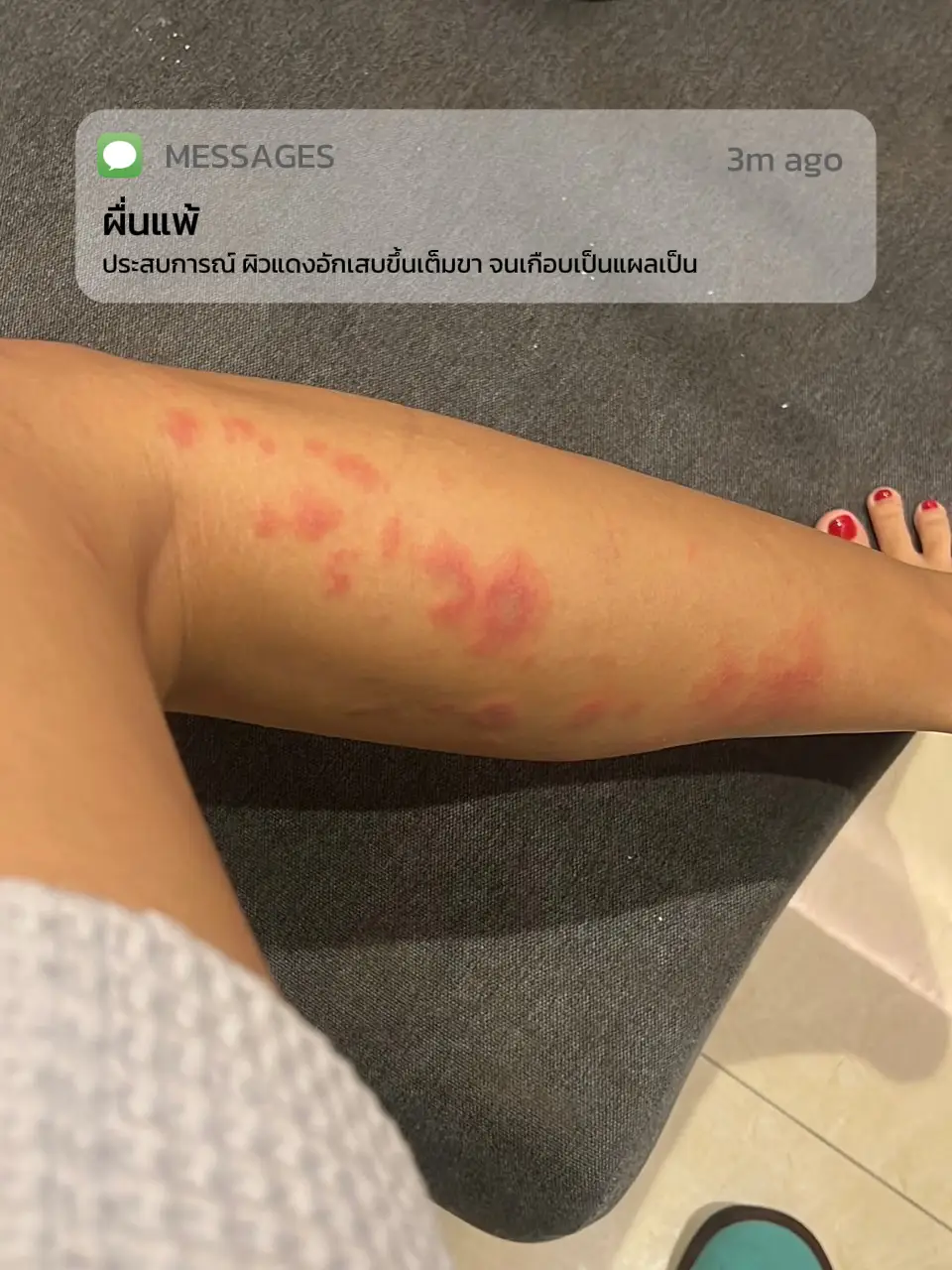 Experience. Red skin inflamed up the whole leg. Almost scarred. 📌 ...