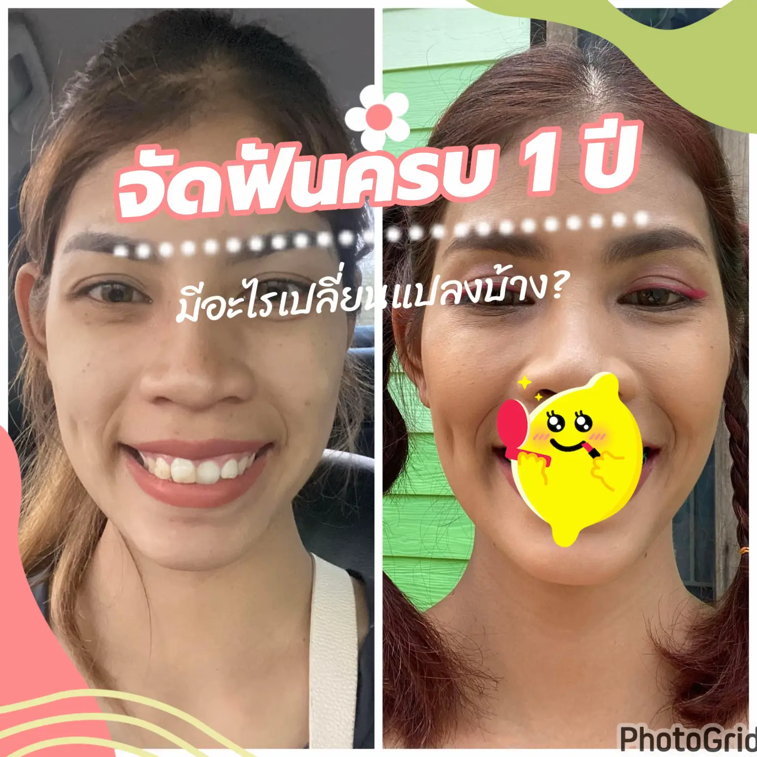 จัดฟันครบ 1 ปีแล้ว มีอะไรเปลี่ยนไปบ้าง? | แกลเลอรีที่โพสต์โดย Ratchaporn Sinm | Lemon8