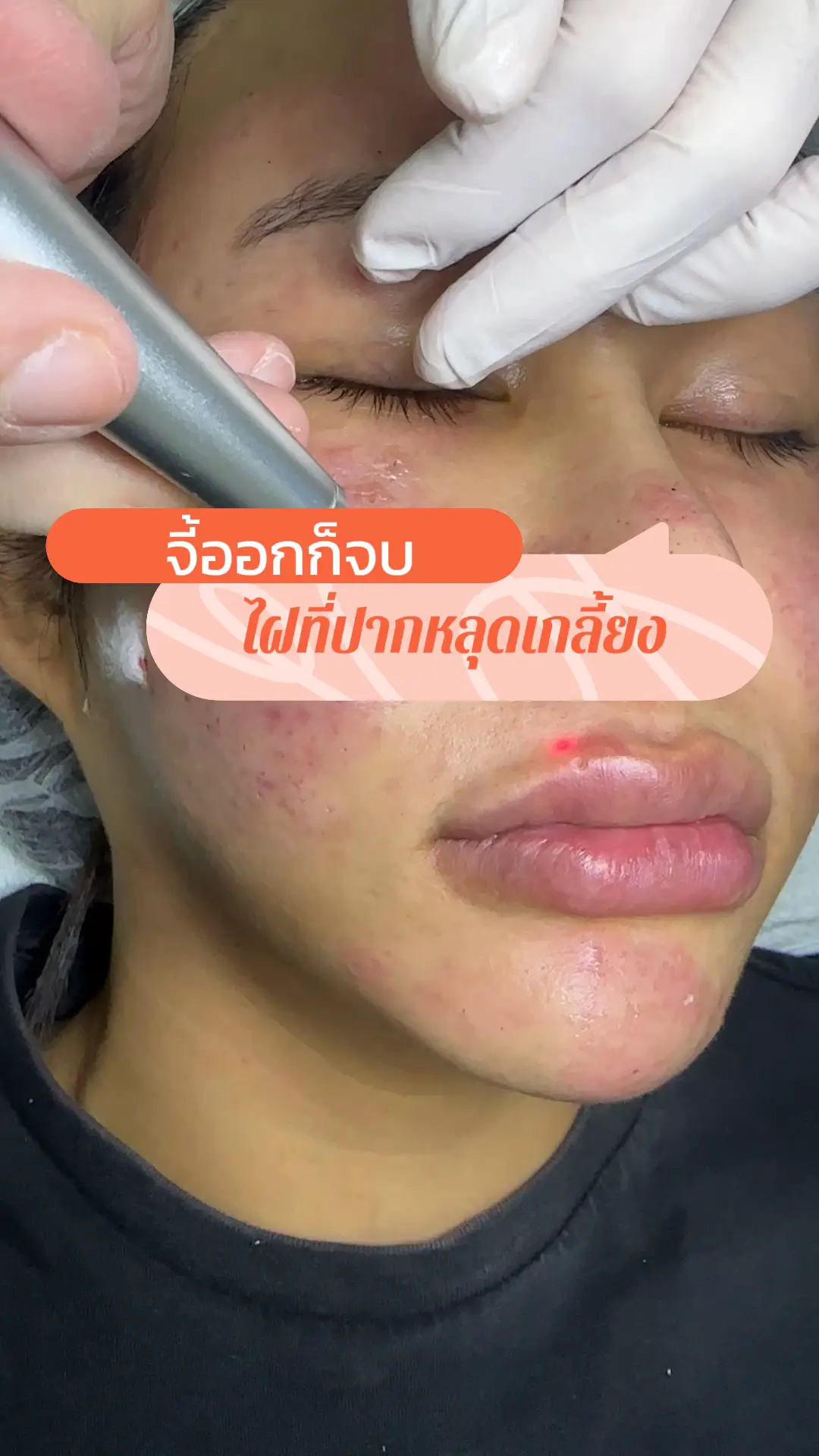 จี้ไฝออกจบ | วิดีโอที่เผยแพร่โดย Dr.Ploy รุ่งนภา | Lemon8