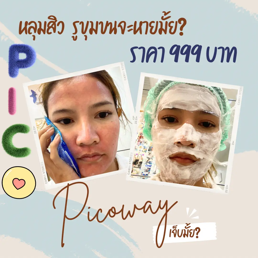 Picoway เจ็บมั้ย เป็นไงมาดูกัน | แกลเลอรีที่โพสต์โดย Tawan Lee | Lemon8