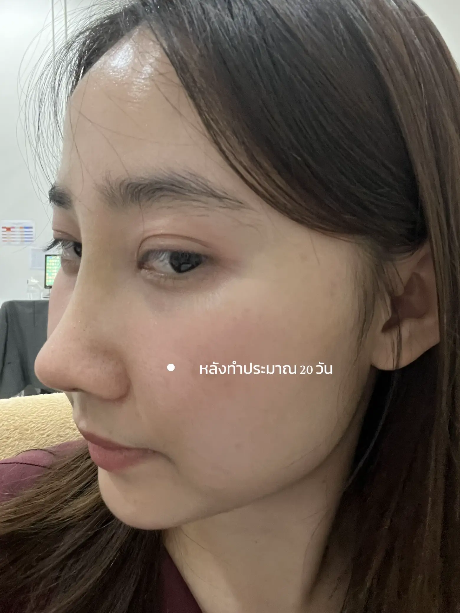 เสริมจมูก 11 เดือน ที่มาอีฟ คลินิก | แกลเลอรีที่โพสต์โดย Hello._.noon ...