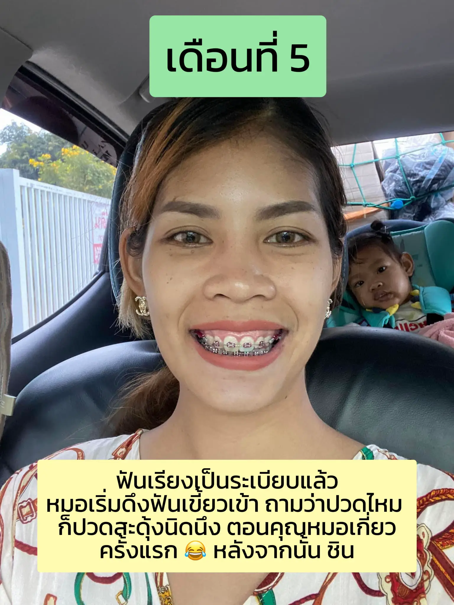 จัดฟันครบ 1 ปีแล้ว มีอะไรเปลี่ยนไปบ้าง? | แกลเลอรีที่โพสต์โดย Ratchaporn Sinm | Lemon8