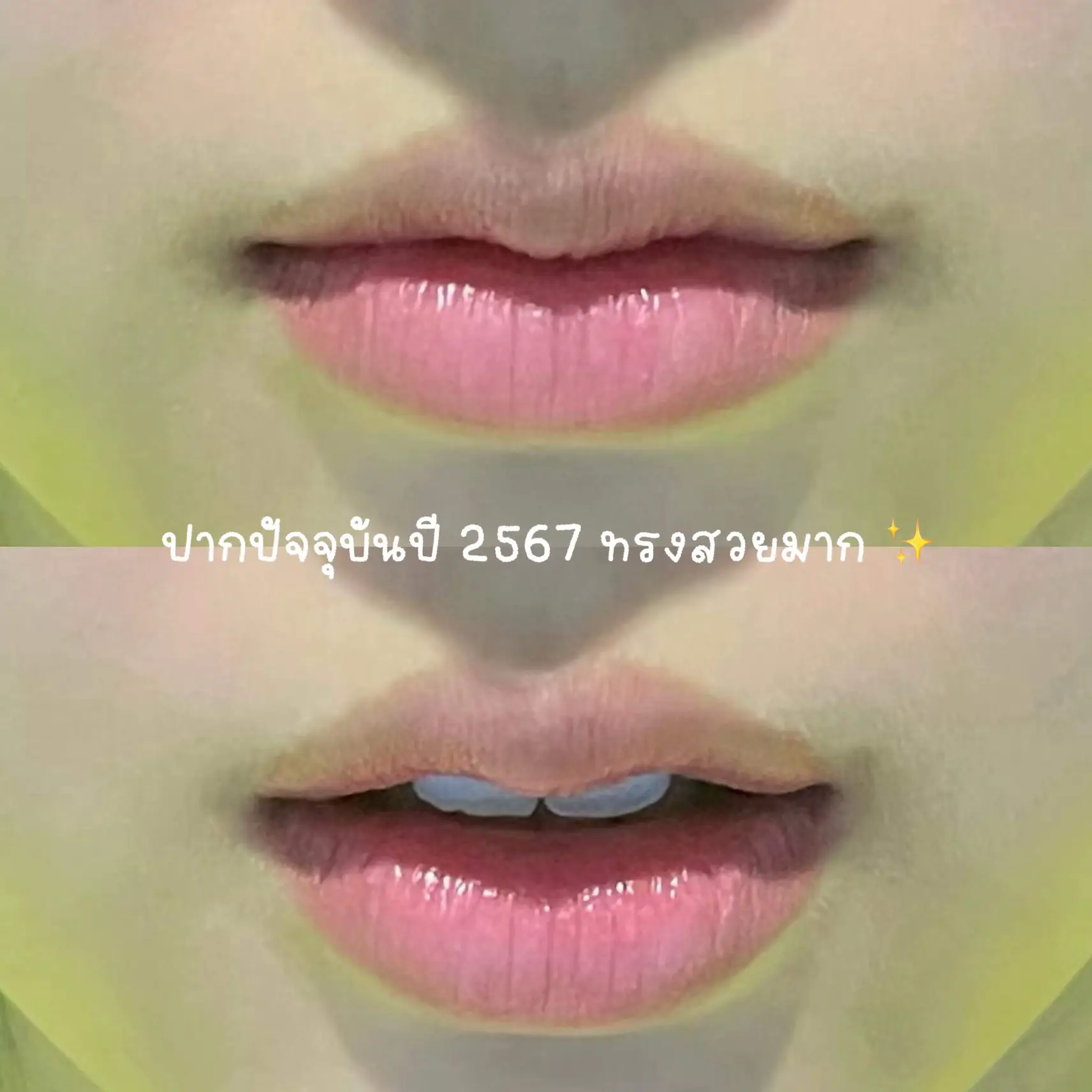 รีวิวตัดปาก กับหมออันดับ1 ของไทย👄 | แกลเลอรีที่โพสต์โดย Orm aam | Lemon8