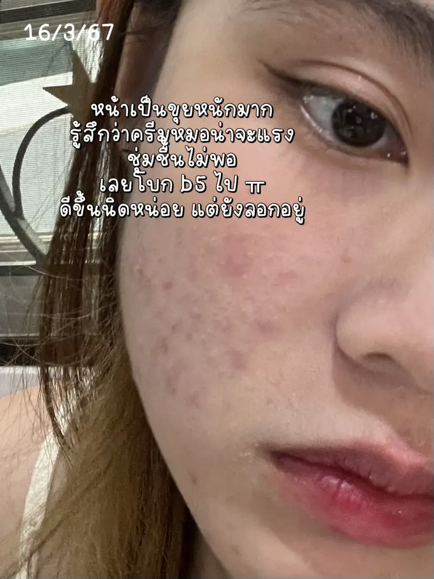 รีวิวหาหมอผิวหนังแพทย์วชิระ ep.2 | แกลเลอรีที่โพสต์โดย Earn.jrp⭐️ | Lemon8