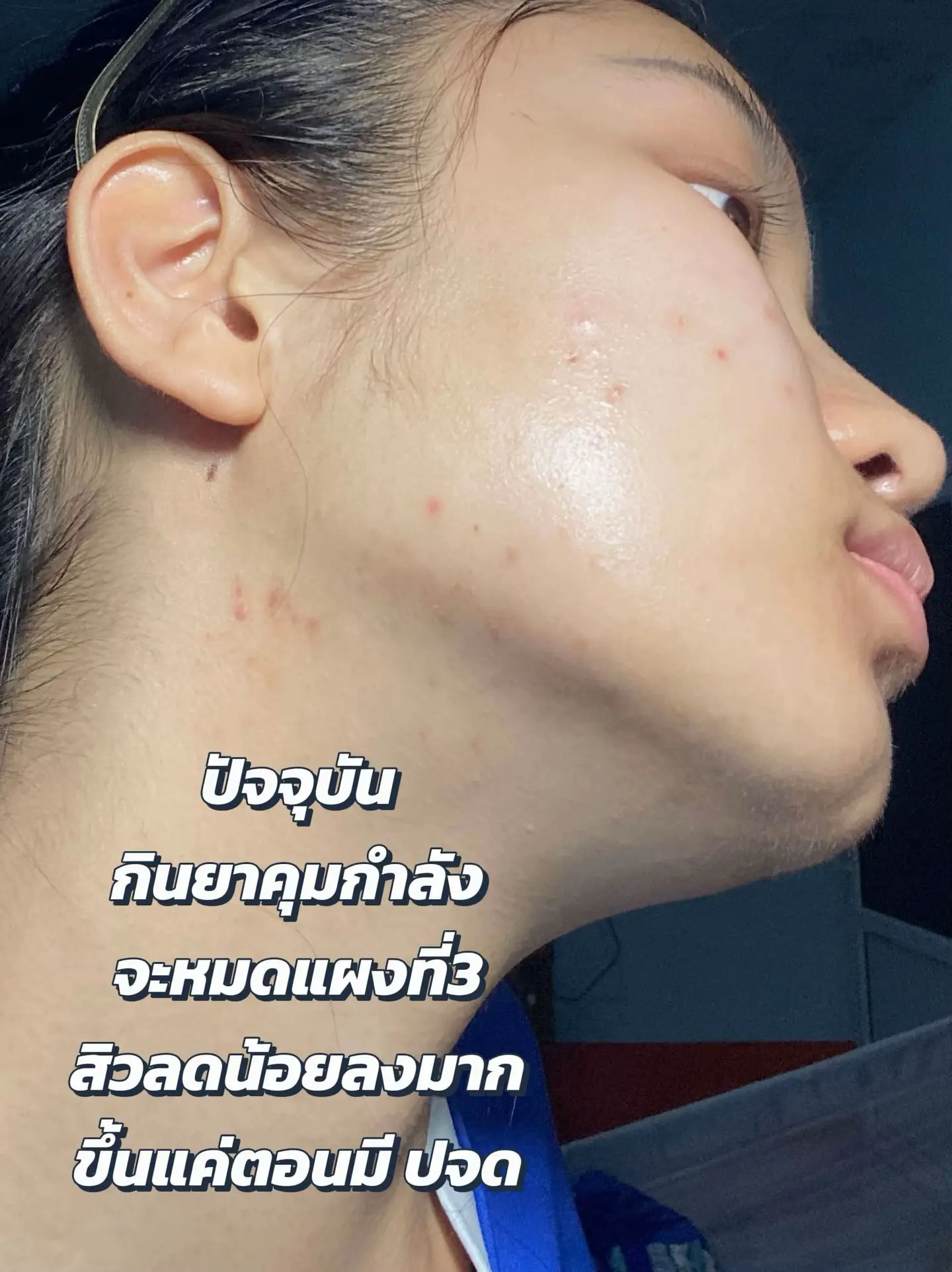 Pcos ตัวร้าย🥲 | แกลเลอรีที่โพสต์โดย Nalinthip | Lemon8