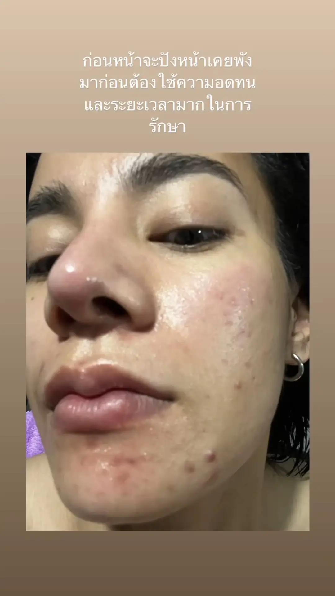 รักษาสิว | วิดีโอที่เผยแพร่โดย 𝔾𝕌𝕀𝕋𝔸ℝ | Lemon8