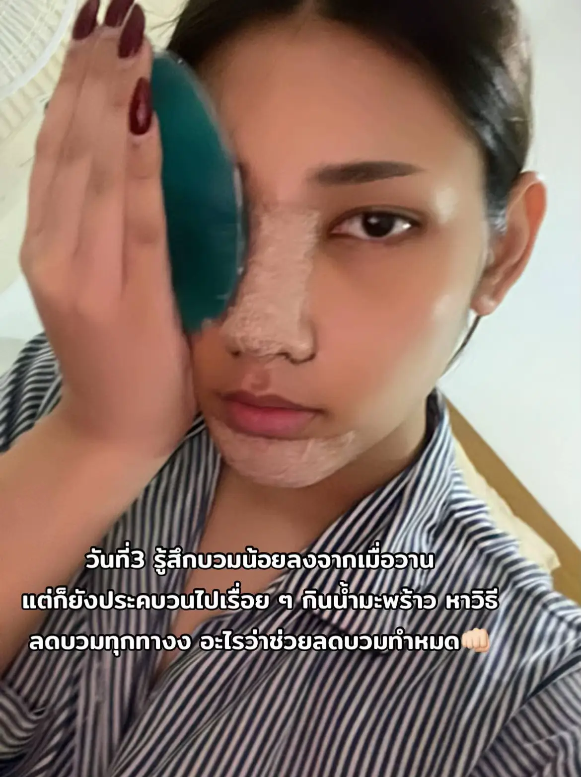 รีวิวประสบการณ์ ทำศัลยกรรมครั้งแรกแต่ไม่เป็นแบบที่คิดด แกลเลอรีที่