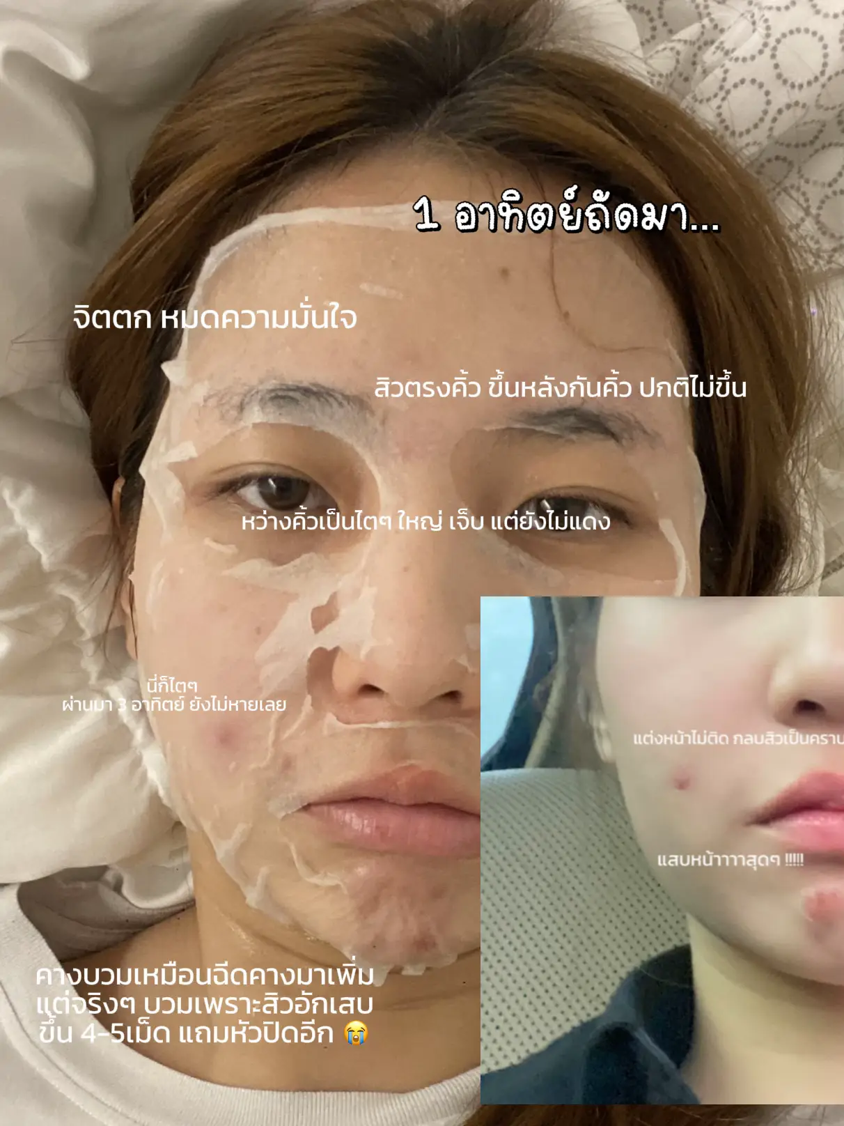 ปราการผิวพัง อยู่ดีๆไม่ชอบ อยากเจ๋อไปใช้ แกลเลอรีที่โพสต์โดย