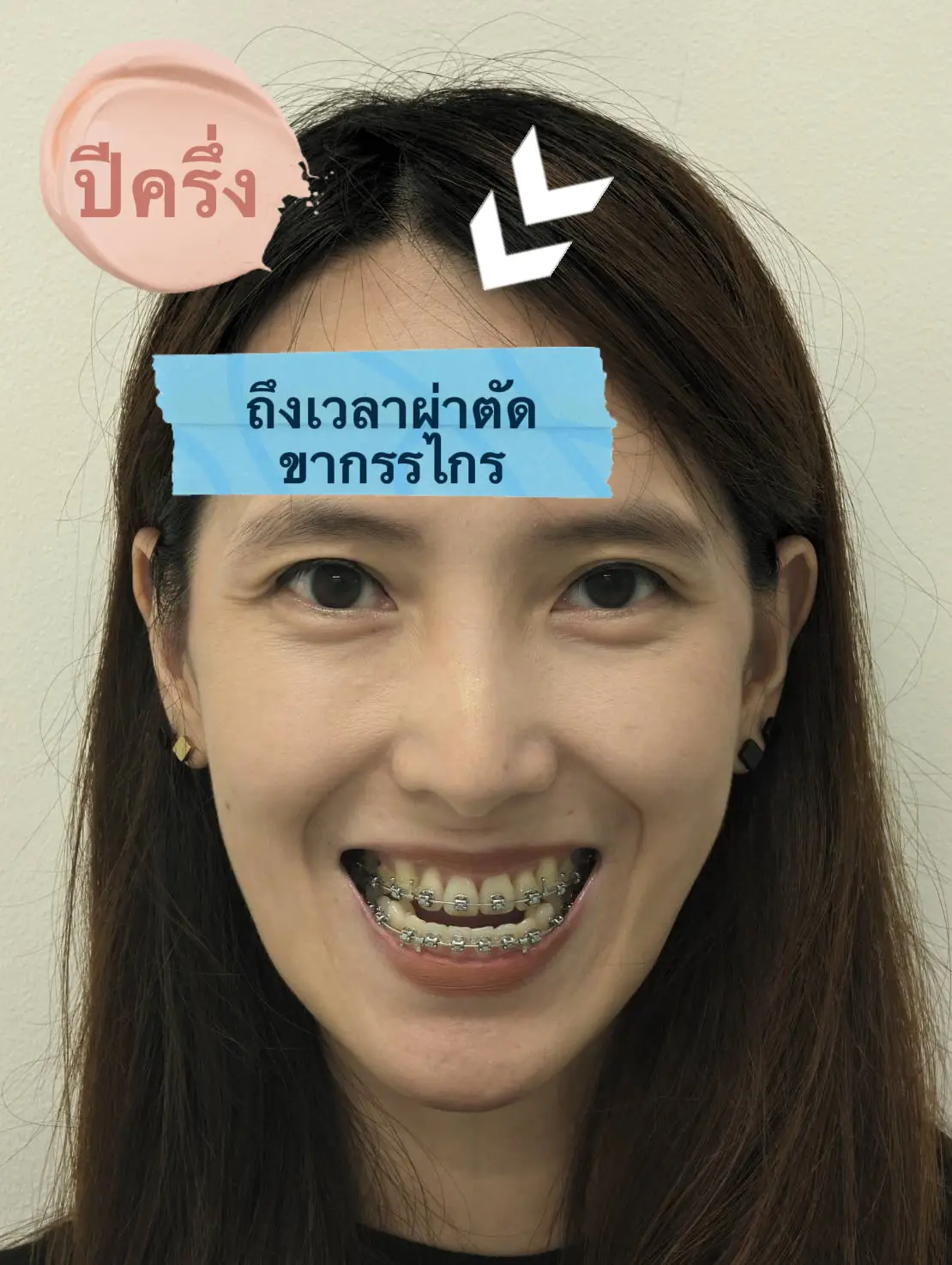รีวิว😃 อายุใกล้ 40 จัดฟัน ยังทันไหม?? แล้วคอมเม้นท์ด้วยน๊าาา | แกลเลอรี ...