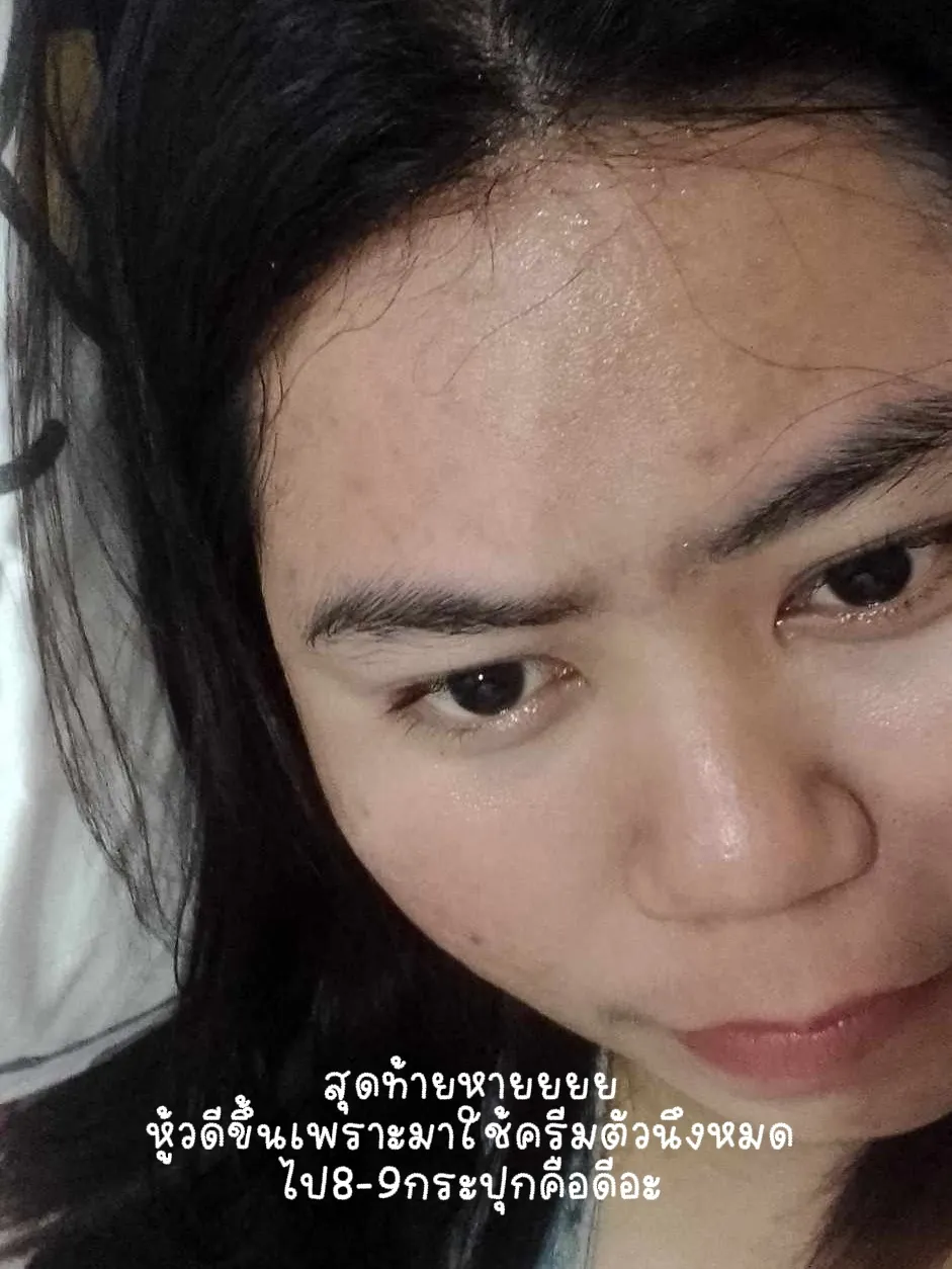 เป็นหนักขนาดนี้จะหายหรอไม่หายหรอกเชื่อดิ? | แกลเลอรีที่โพสต์โดย Diw | Lemon8