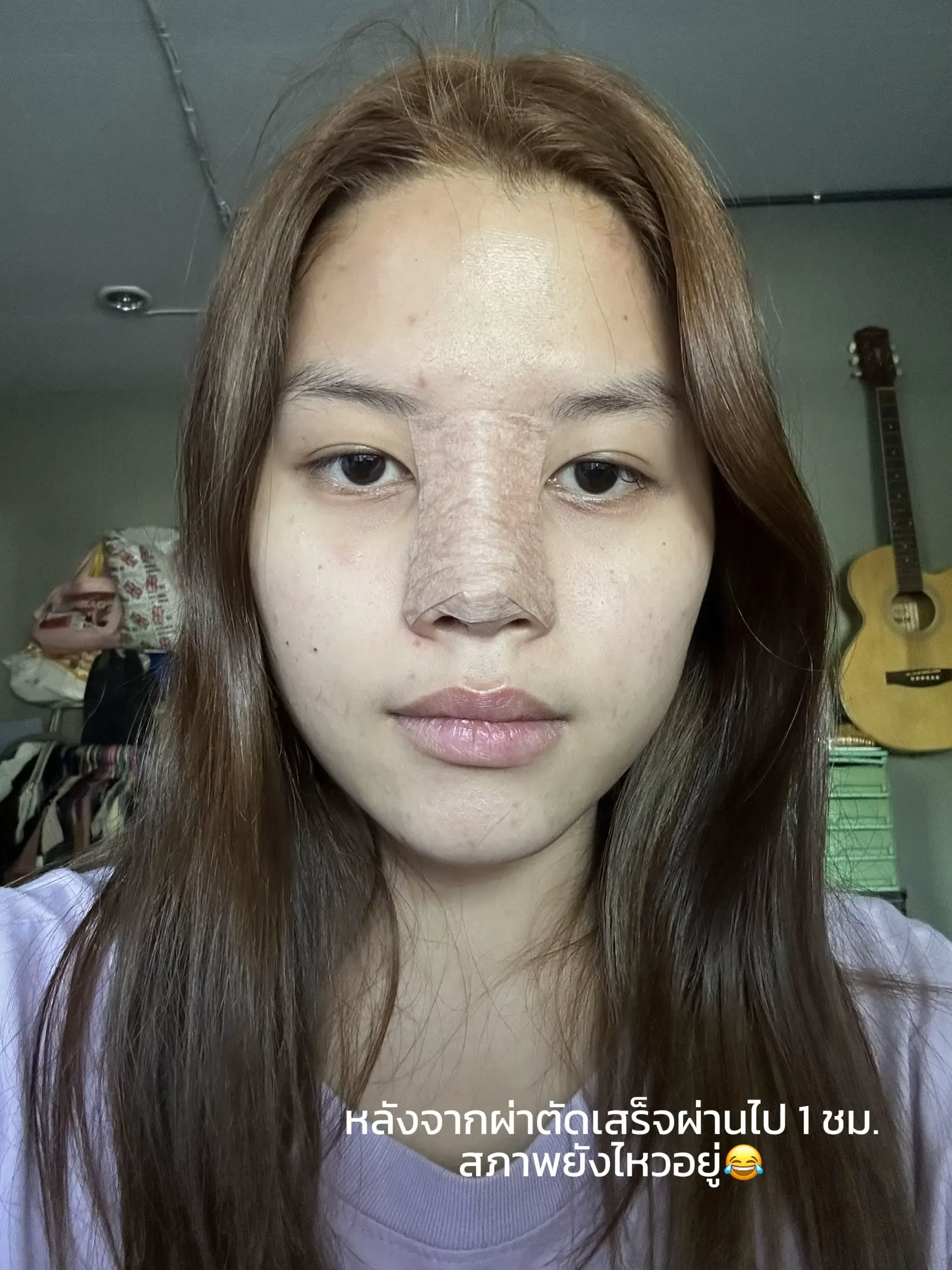 ศัลยกรรมจมูกครั้งแรกที่ Emma Clinic🥰💕 | แกลเลอรีที่โพสต์โดย 🍃~ Fernny💗 🌷 | Lemon8