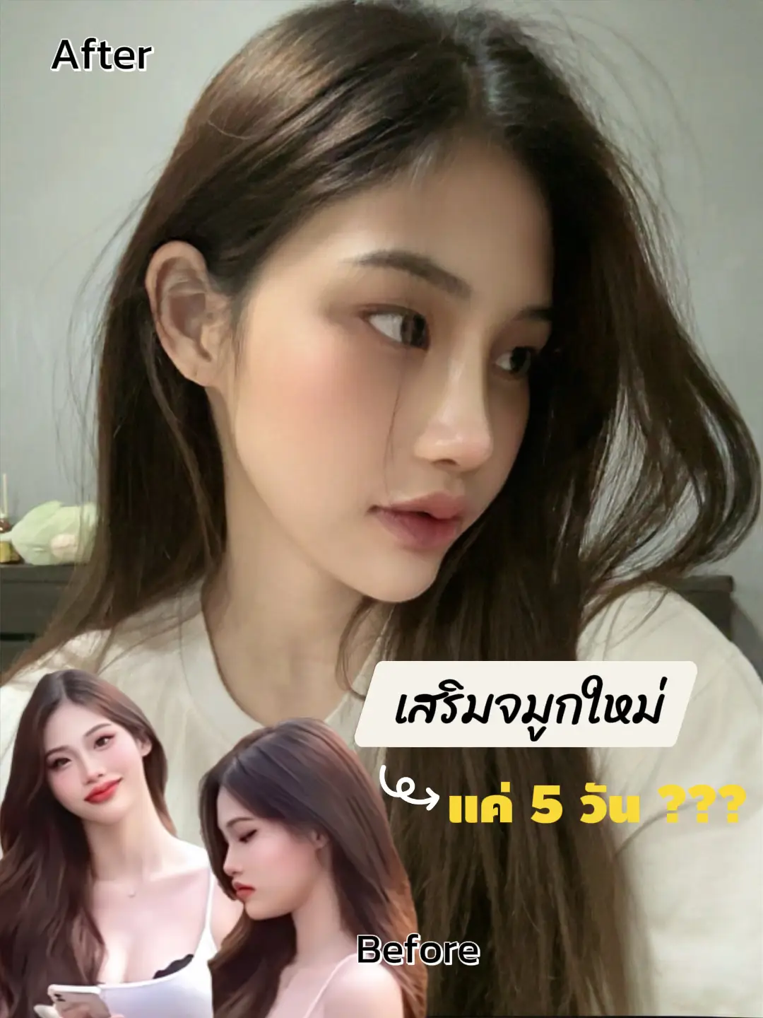 เสริมจมูกใหม่ 5 วันได้แบบนี้??? | แกลเลอรีที่โพสต์โดย Yume | Lemon8