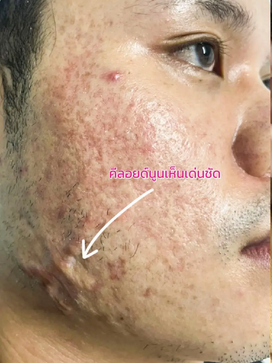 เคสรักษาหลุมสิว+สิวคีลอยด์ | แกลเลอรีที่โพสต์โดย Dr.Ploy รุ่งนภา | Lemon8