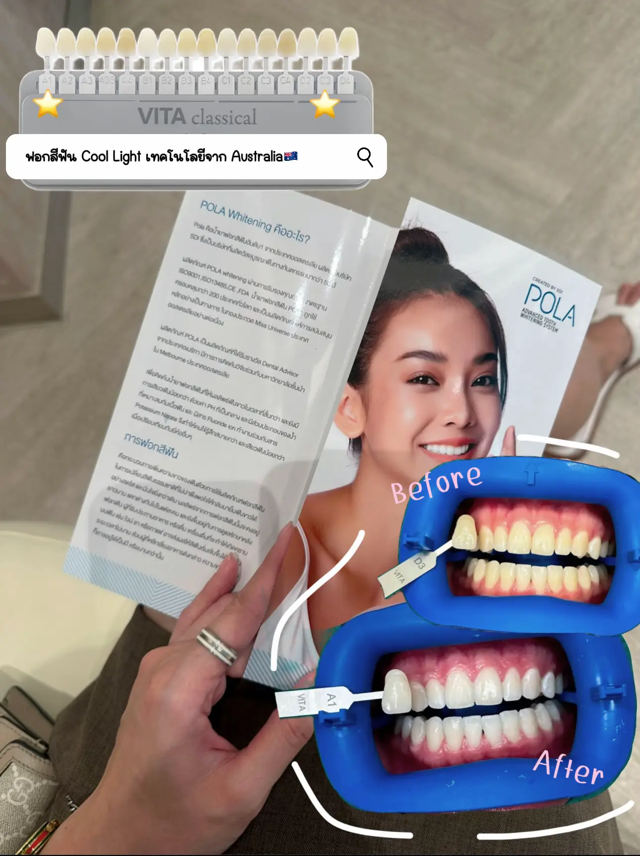 ฟอกสีฟัน Cool Light🇦🇺 ติดBTS | BRIGHT DENTAL STUDIO | แกลเลอรีที่โพสต์ ...