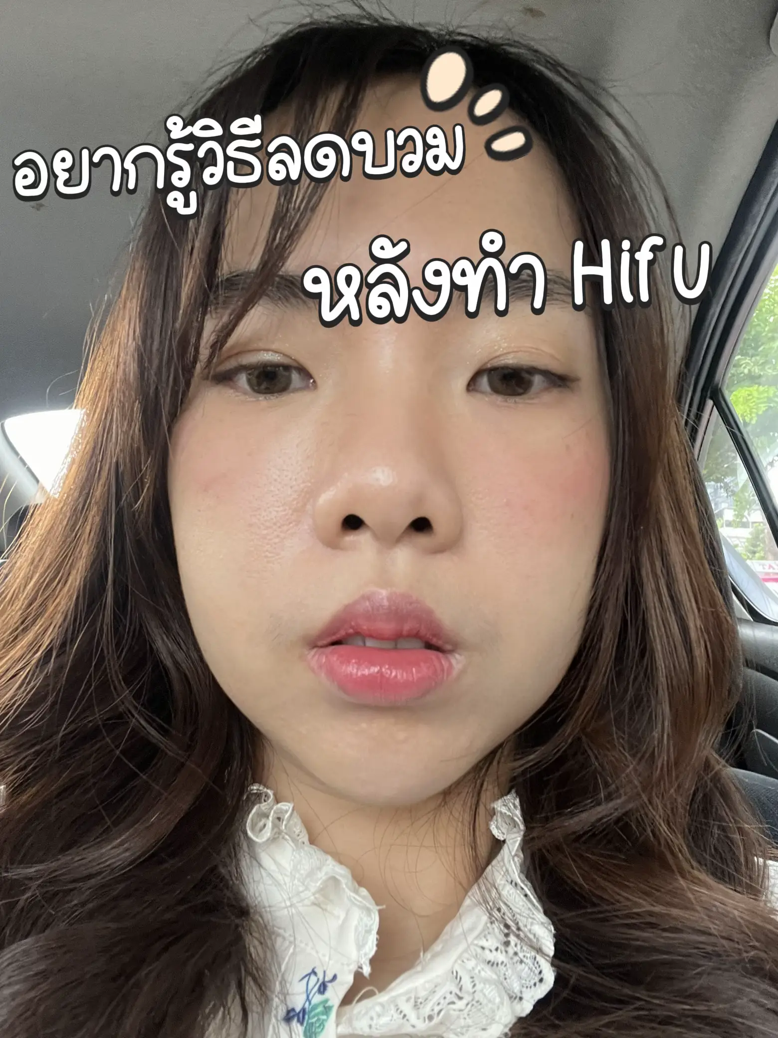 อยากรู้วิธีลดบวมหลัง Hifu | แกลเลอรีที่โพสต์โดย Sa Thananchamon | Lemon8