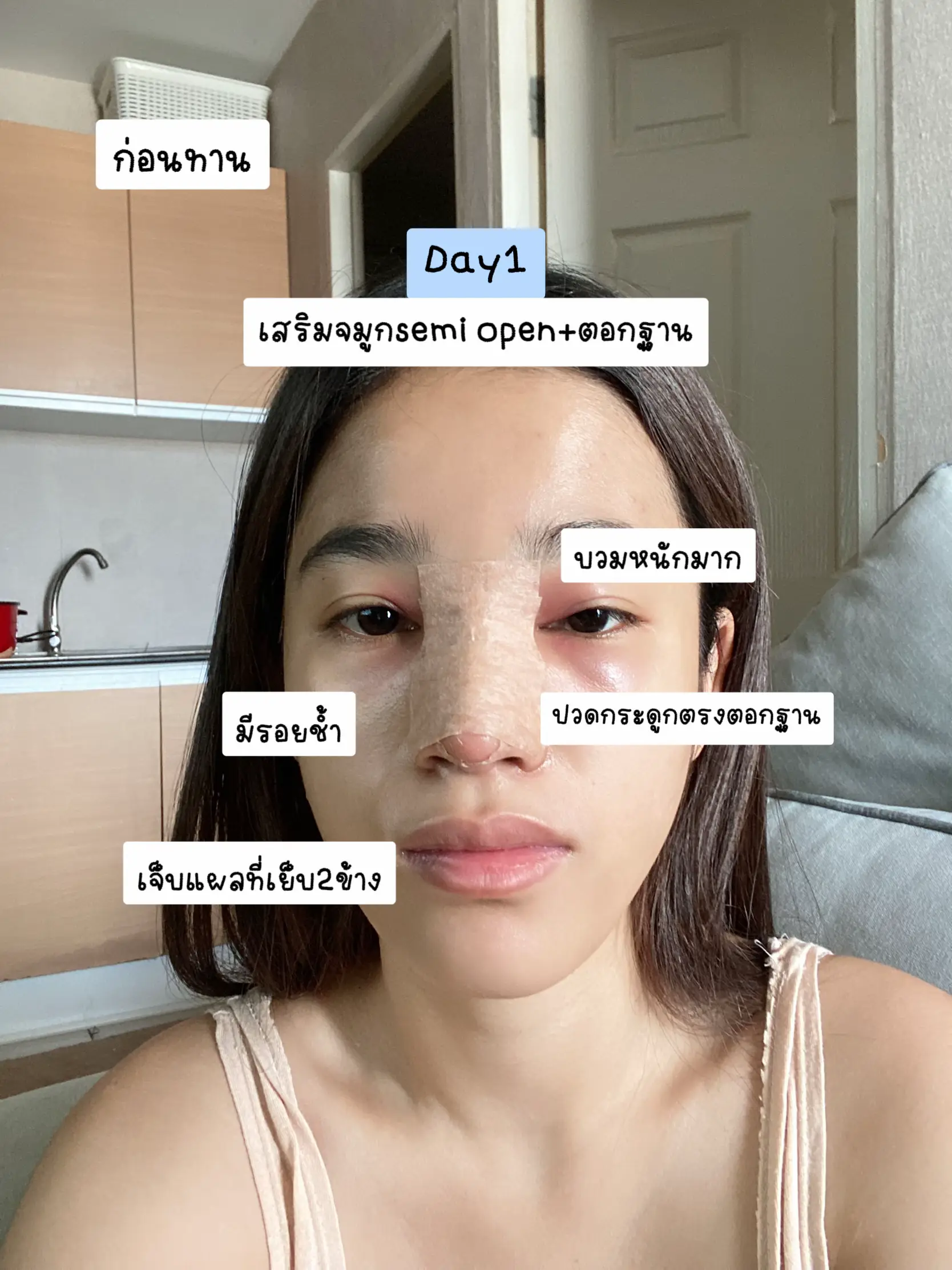 ลดบวม Proctase-P คือ ยา แก้ อะไร - การค้นหาใน Lemon8