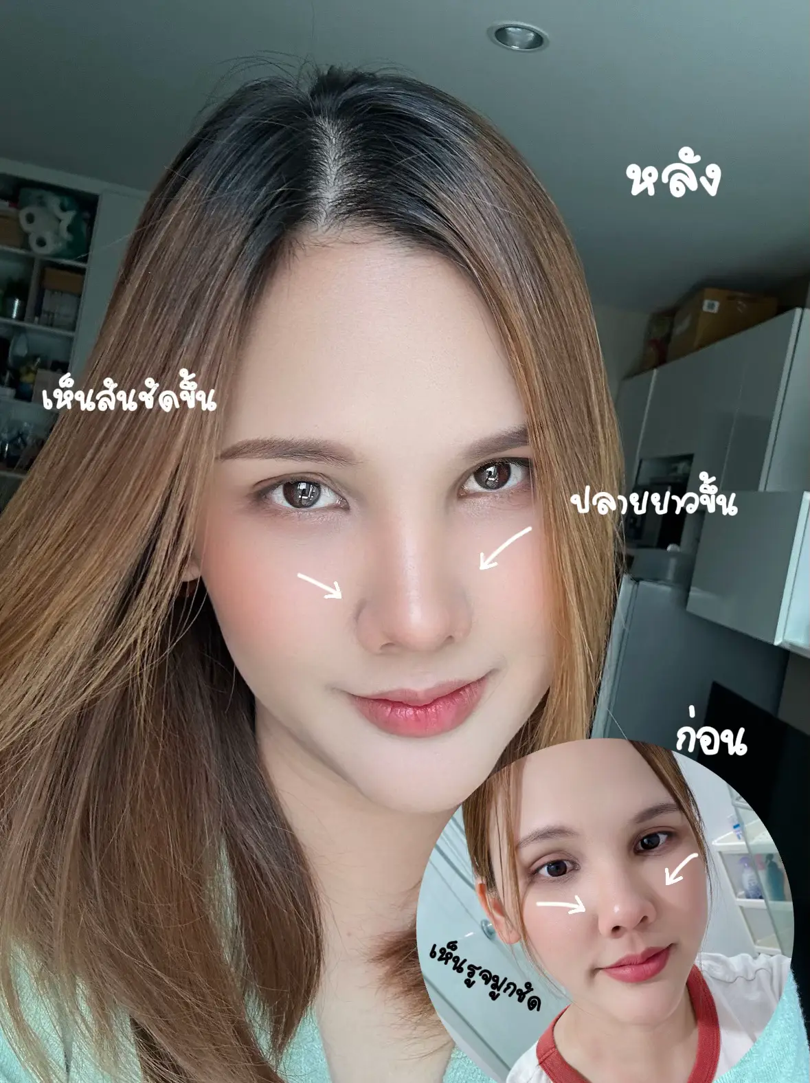 สันจมูกใหญ่👃🏻ทำจมูกแท่งแรก งบ