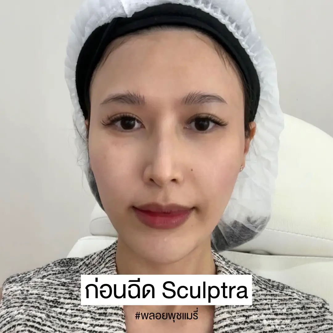 รีวิวการฉีด #Sculptra แบบเจาะลึก | แกลเลอรีที่โพสต์โดย พลอย พุชแมรี่ ...