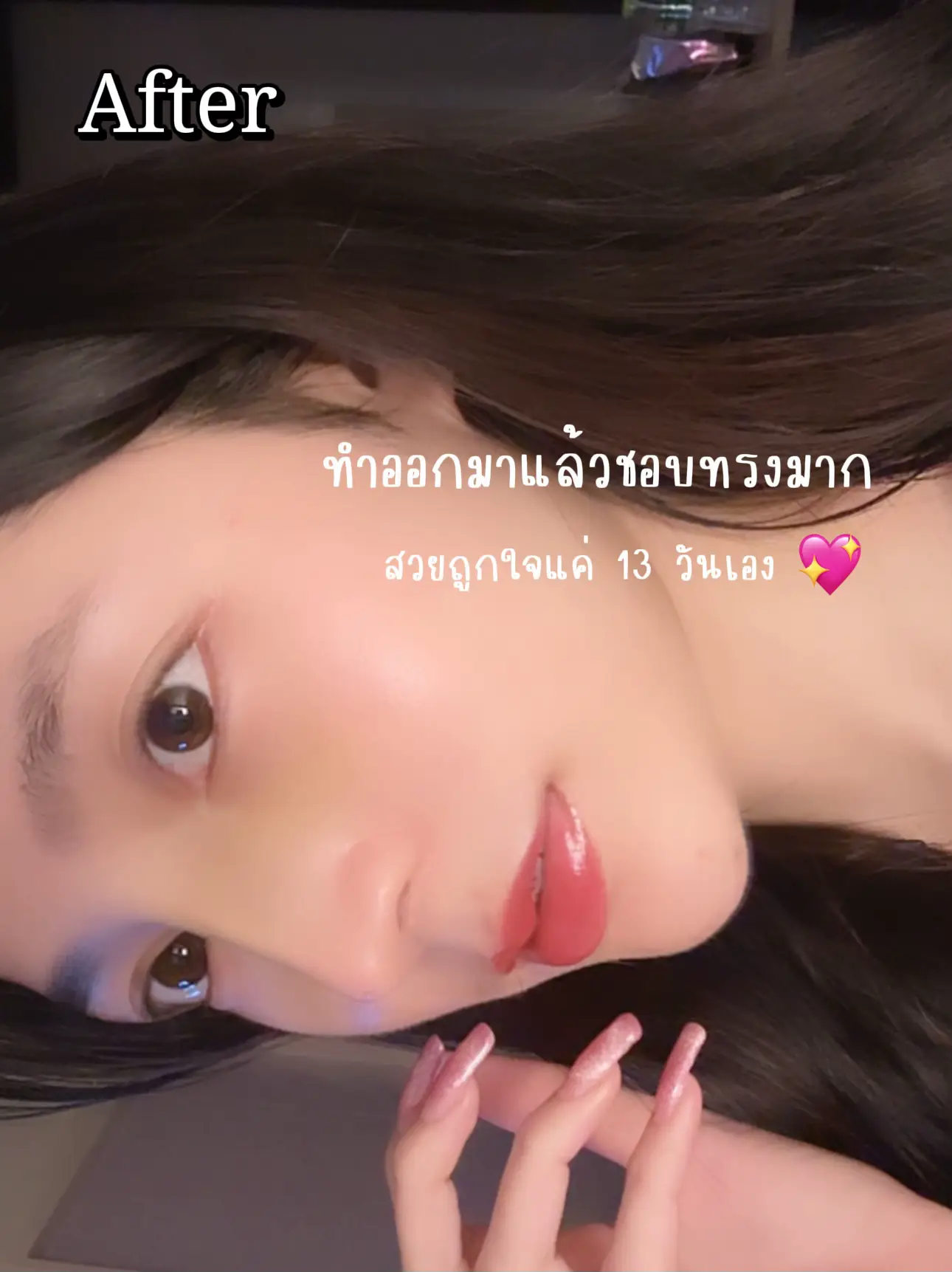 เสริมจมูกครั้งแรกที่ Emma Clinic 💖 | แกลเลอรีที่โพสต์โดย minemint🐰 | Lemon8