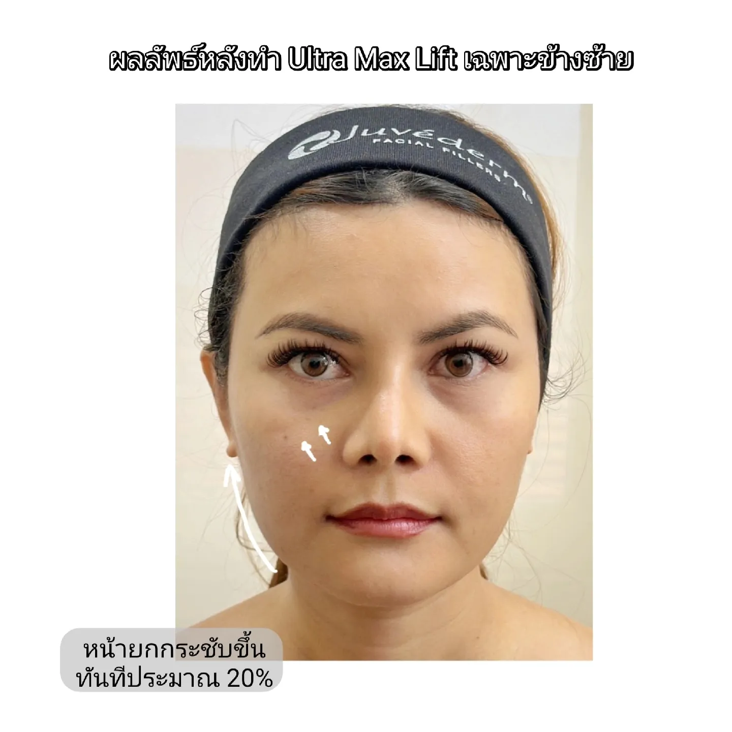 Ultra Max Lift หน้าเรียว ไม่ง้อเข็ม💉 | แกลเลอรีที่โพสต์โดย ...