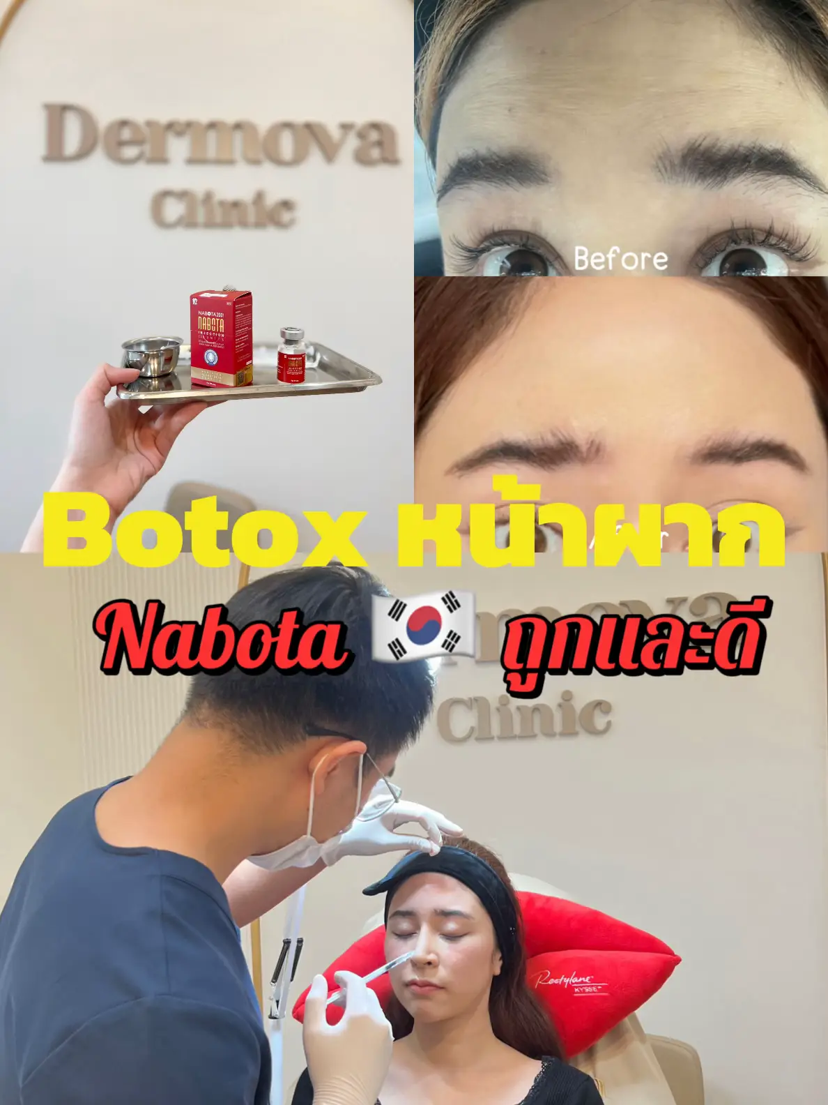 รีวิวคนอายุ 20 ต้นๆ ฉีด Botox Nabota🇰🇷 ถูกและดี🫣 | แกลเลอรีที่โพสต์โดย ...