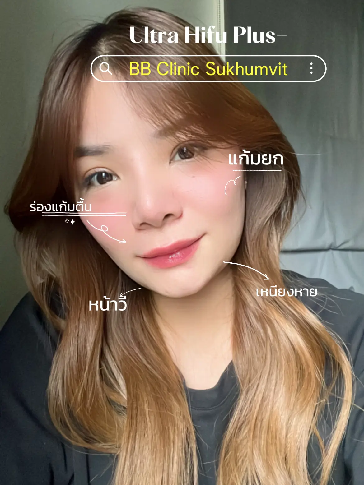 รีวิว Ultramax Hifu - การค้นหาใน Lemon8