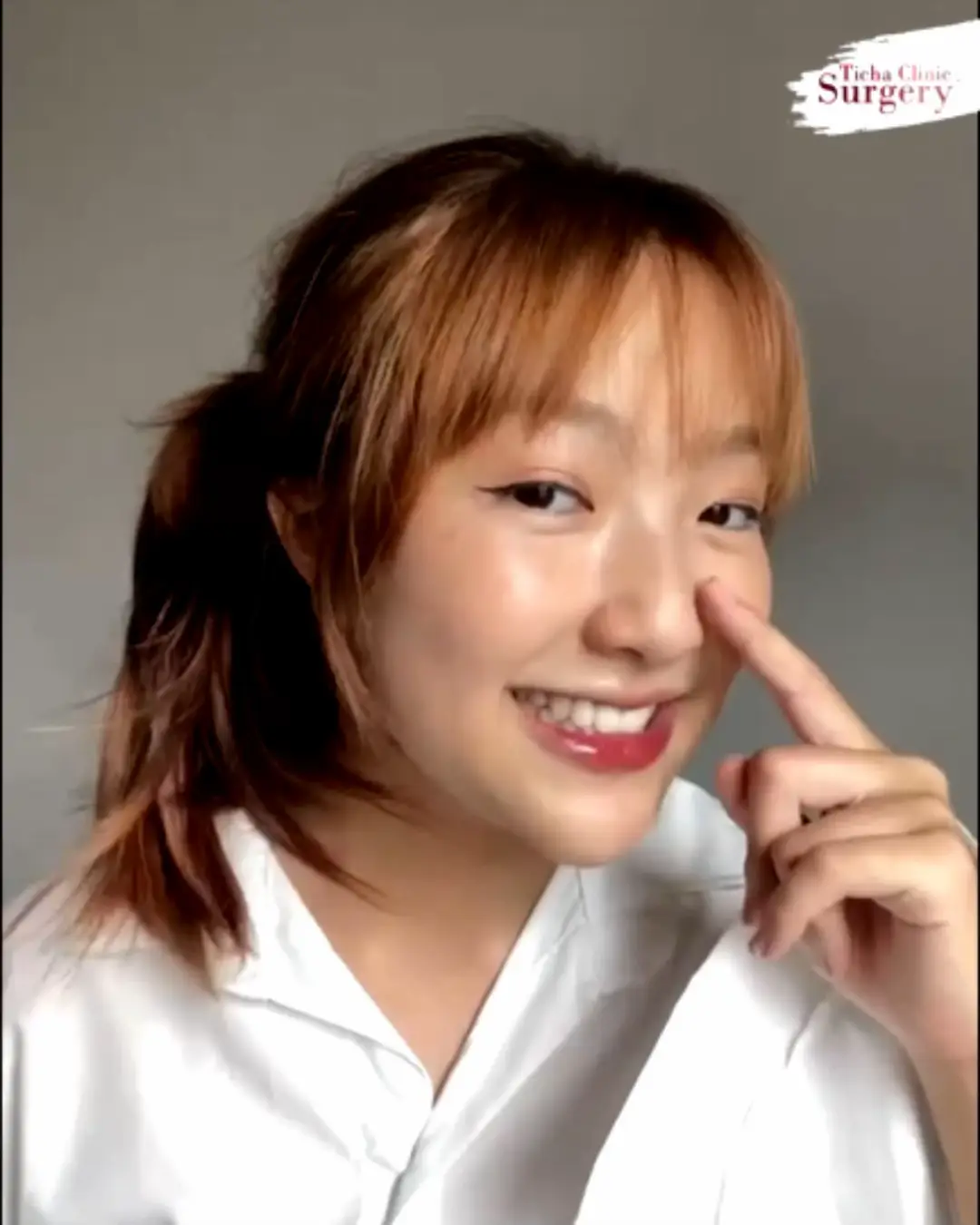 เสริมจมูกแล้วหน้าเปลี่ยนจริง!!! | วิดีโอที่เผยแพร่โดย Ticha Clinic | Lemon8