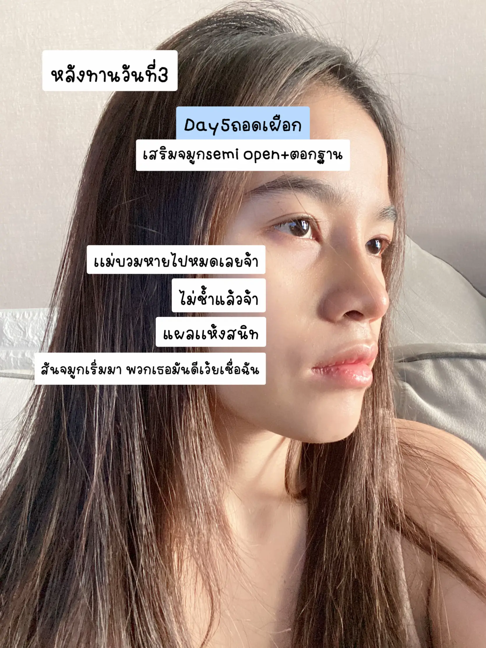 ลดบวม Proctase-P คือ ยา แก้ อะไร - การค้นหาใน Lemon8