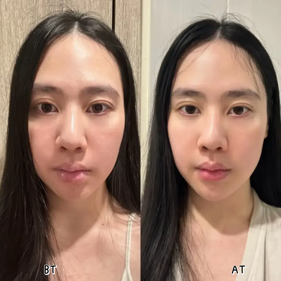 ป้ายยา CURECODE มอยส์คนเป็นสิวผิวมัน ที่คุณหมอแนะนำ! 💁🏻‍♀️ | แกลเลอรีที่โพสต์โดย Chanan🍅🥦 | Lemon8