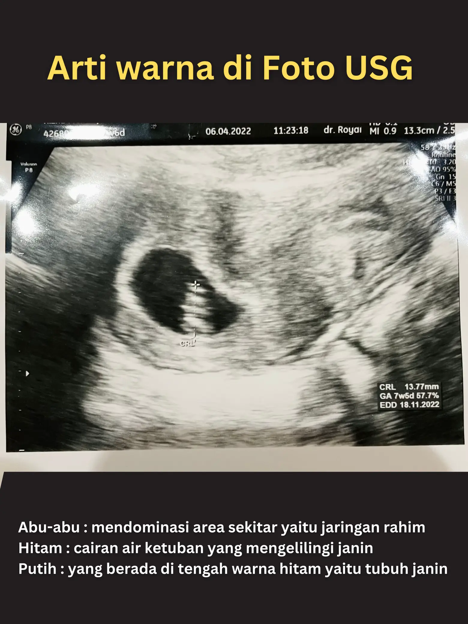 Jangan Salah, Begini Cara Baca Hasil USG Kehamilan | Galeri diposting oleh Ilaays | Lemon8