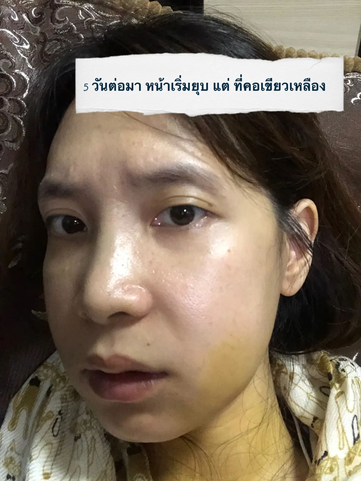 ภาคต่อ ประสบการณ์ผ่าตัดขากรรไกร 7วันแรก | แกลเลอรีที่โพสต์โดย PpSAmE | Lemon8