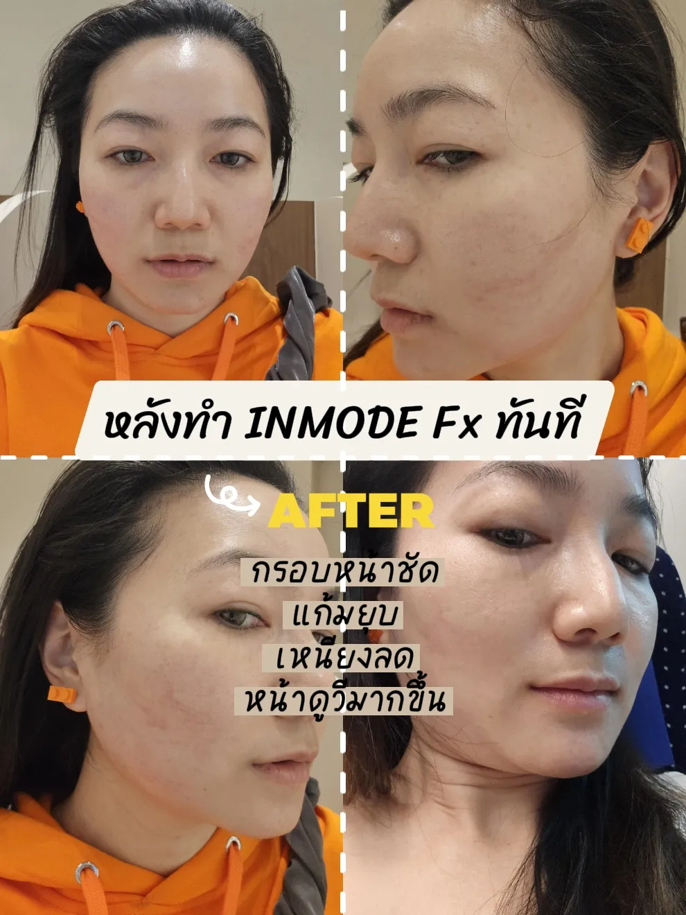 INMODE Fx ที่เกาหลี🇰🇷 ไม่ถึง 2 ใบเทา | แกลเลอรีที่โพสต์โดย Pearllii🐚🔮 | Lemon8