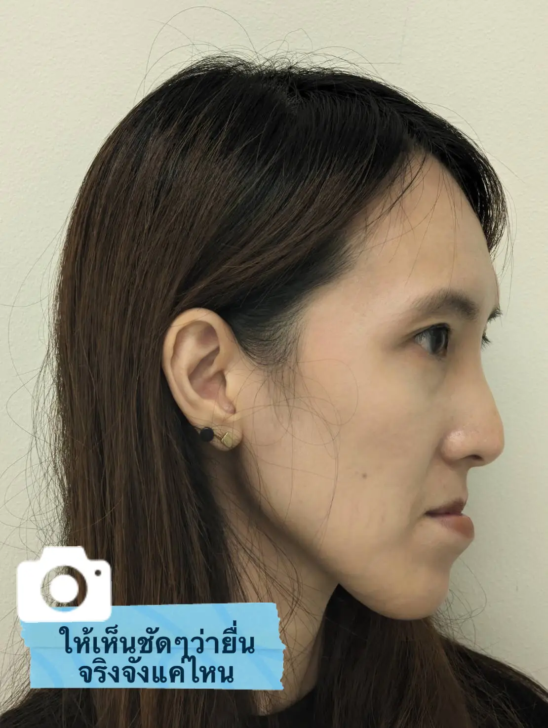 รีวิว😃 อายุใกล้ 40 จัดฟัน ยังทันไหม?? แล้วคอมเม้นท์ด้วยน๊าาา | แกลเลอรี ...