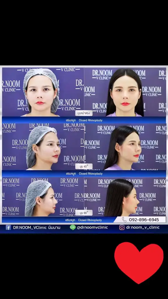 รีวิว “แก้จมูก” กับศัลยแพทย์ที่เขียงใหม่ | วิดีโอที่เผยแพร่โดย Dr.Noom Surgery | Lemon8