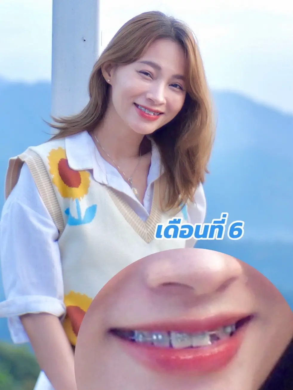 รีวิวจัดฟัน ในวัยเลข4 | แกลเลอรีที่โพสต์โดย Goonggiヅ กุ้งกิ | Lemon8