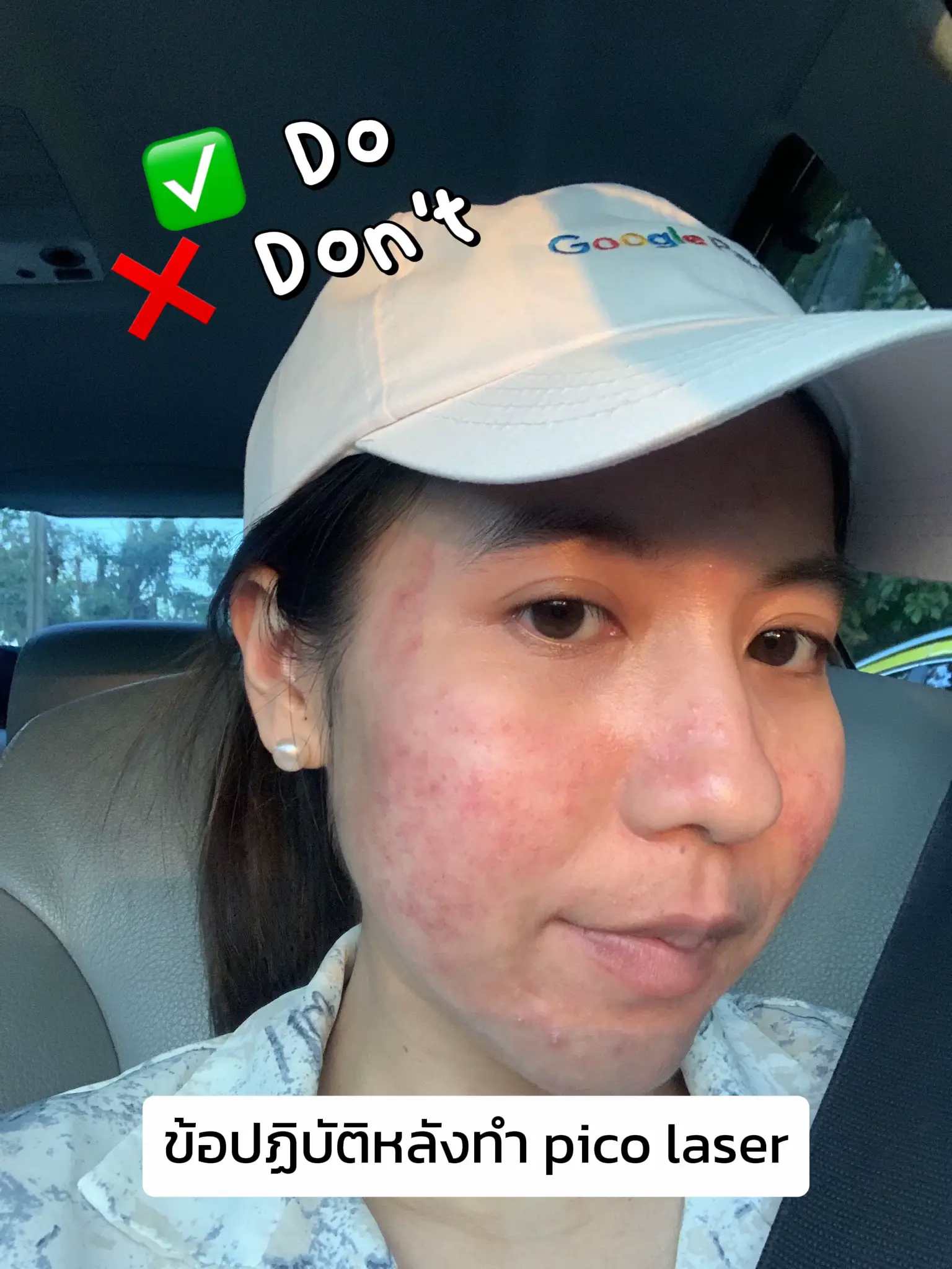 📌How to ดูแลผิวหลังทำ pico laser 💉 | แกลเลอรีที่โพสต์โดย Praewpipat | Lemon8