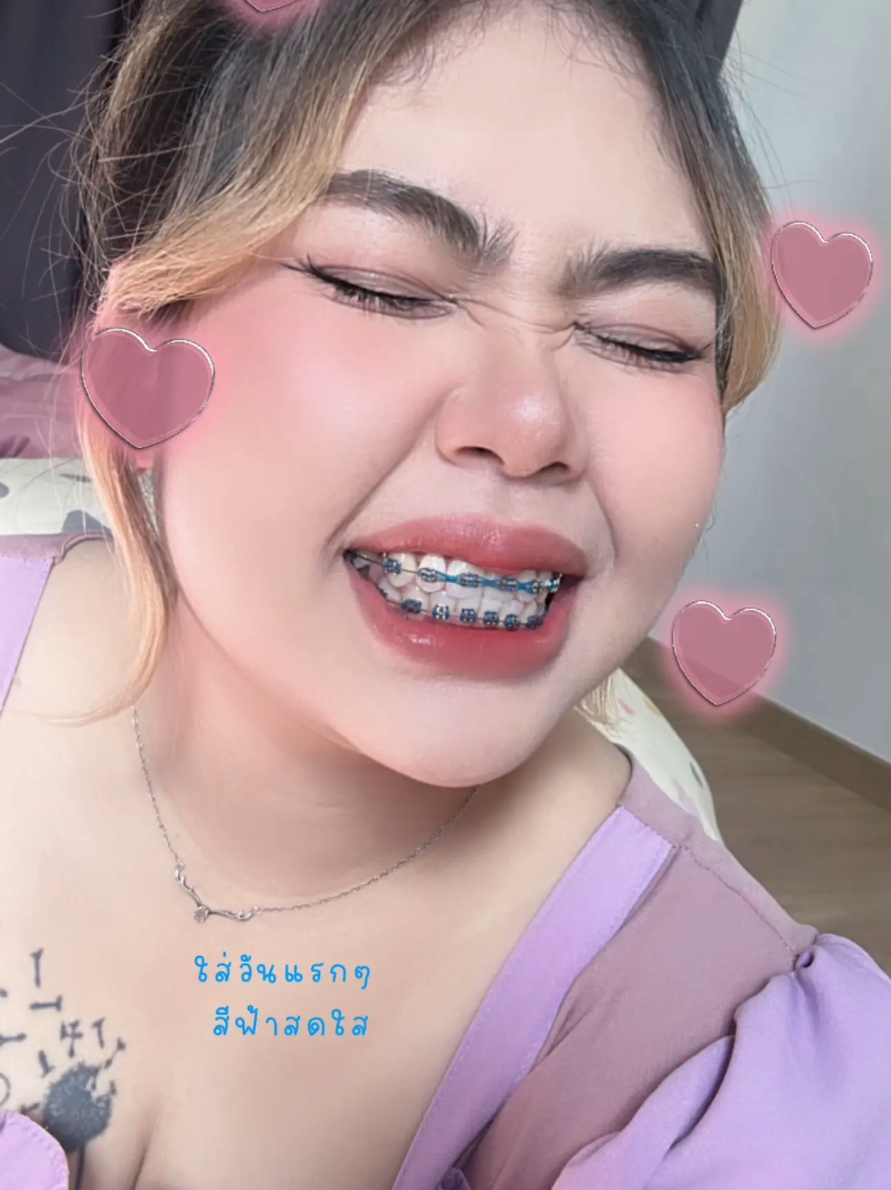 รีวิวสียางจัดฟัน 😍 | แกลเลอรีที่โพสต์โดย Noon_YK | Lemon8