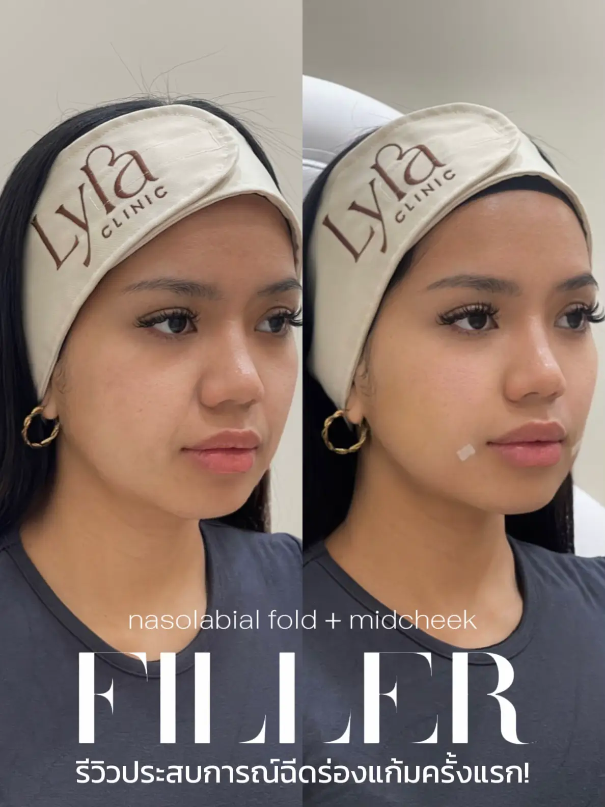 MIDCHEEK GROOVE FILLER | ฉีดแล้วหน้าดูเด็กลง5ปี! | แกลเลอรีที่โพสต์โดย ...