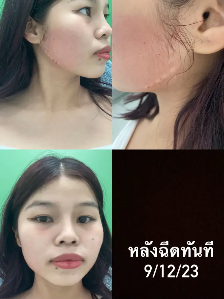 ฉีดโบกราม+ลิฟต์กรอบหน้าครั้งแรก | แกลเลอรีที่โพสต์โดย 𝐄𝐫𝐧𝐠 𝐀𝐨𝐞𝐲 | Lemon8