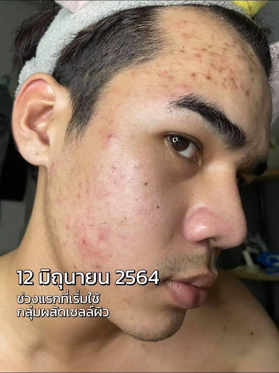 รักษาสิวด้วยตัวเอง ตามกำลังทรัพย์ | แกลเลอรีที่โพสต์โดย Ins_pire | Lemon8