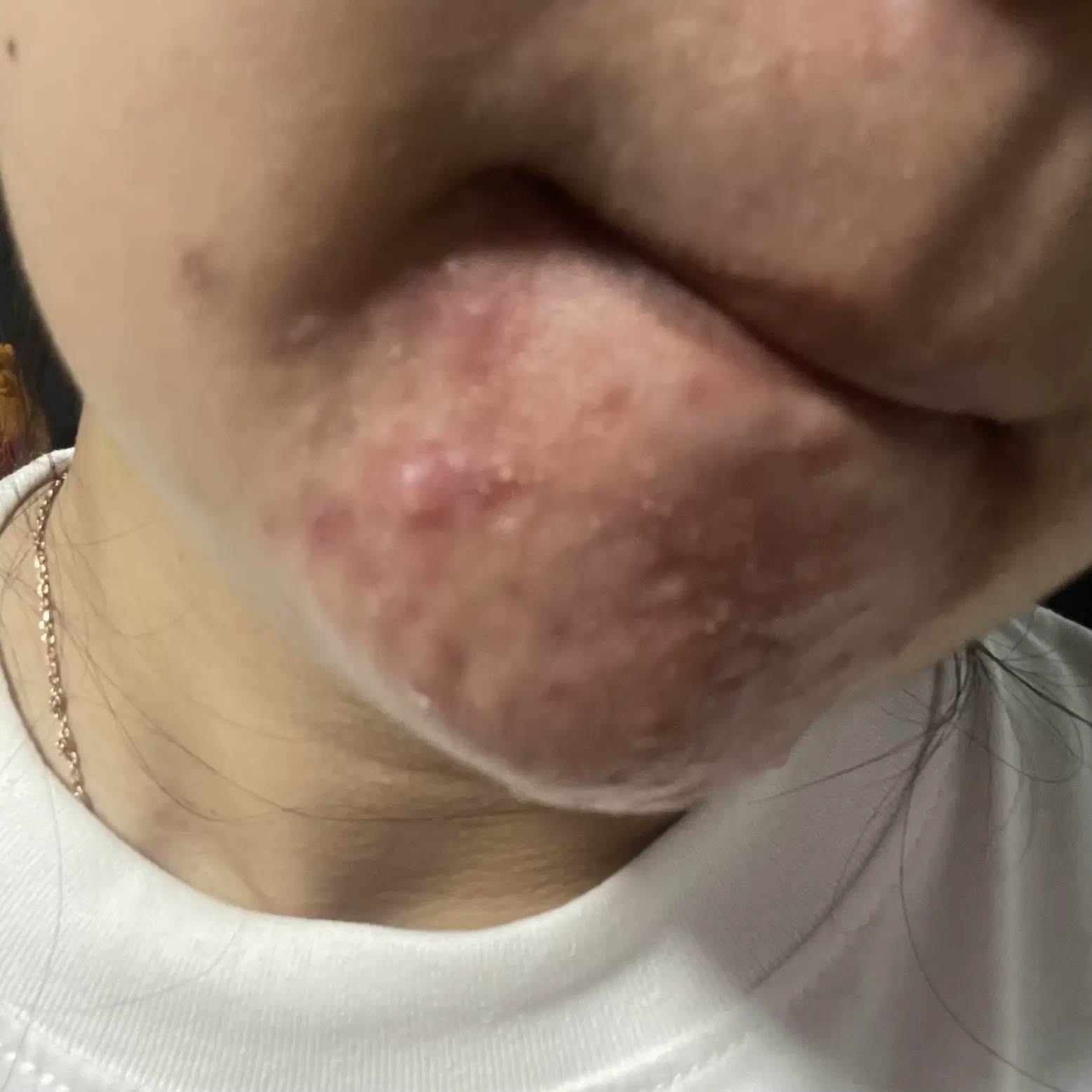 #ช่วยด้วยค่ะสิวแบบนี้รักษายังไงดี | แกลเลอรีที่โพสต์โดย phcrpn_beau ...