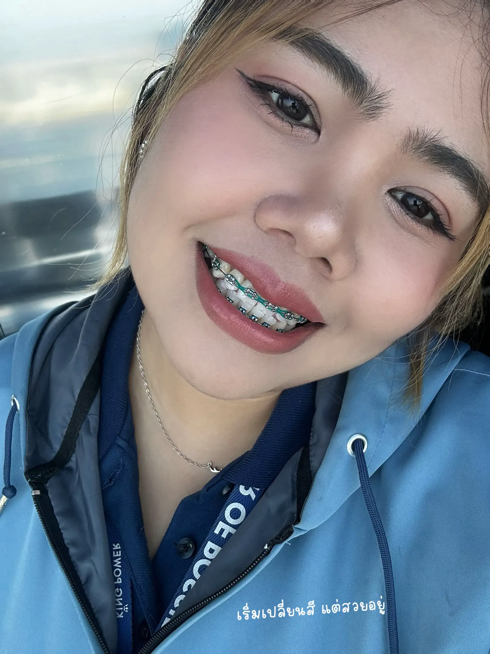 รีวิวสียางจัดฟัน 😍 | แกลเลอรีที่โพสต์โดย Noon_YK | Lemon8