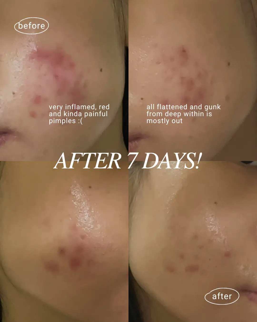 i got rid of my hormonal breakouts in a week 🏼 | Gallery posted by ...