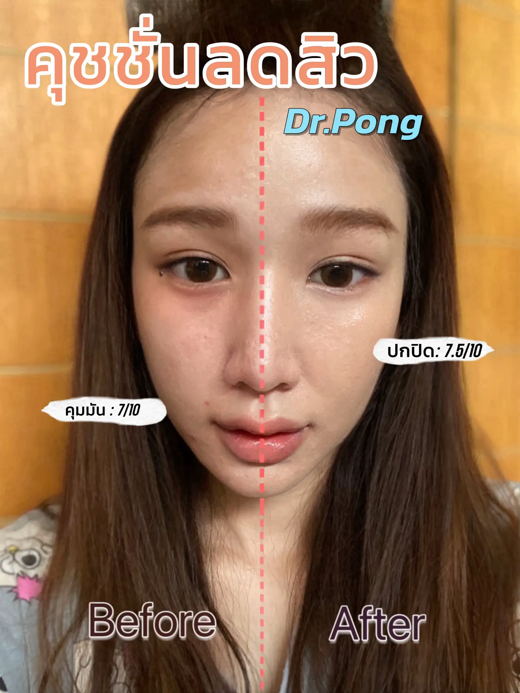 Dr.PONG ACNE ACE Longwear Cushion คุชชั่นลดสิว | แกลเลอรีที่โพสต์โดย Niira.J | Lemon8