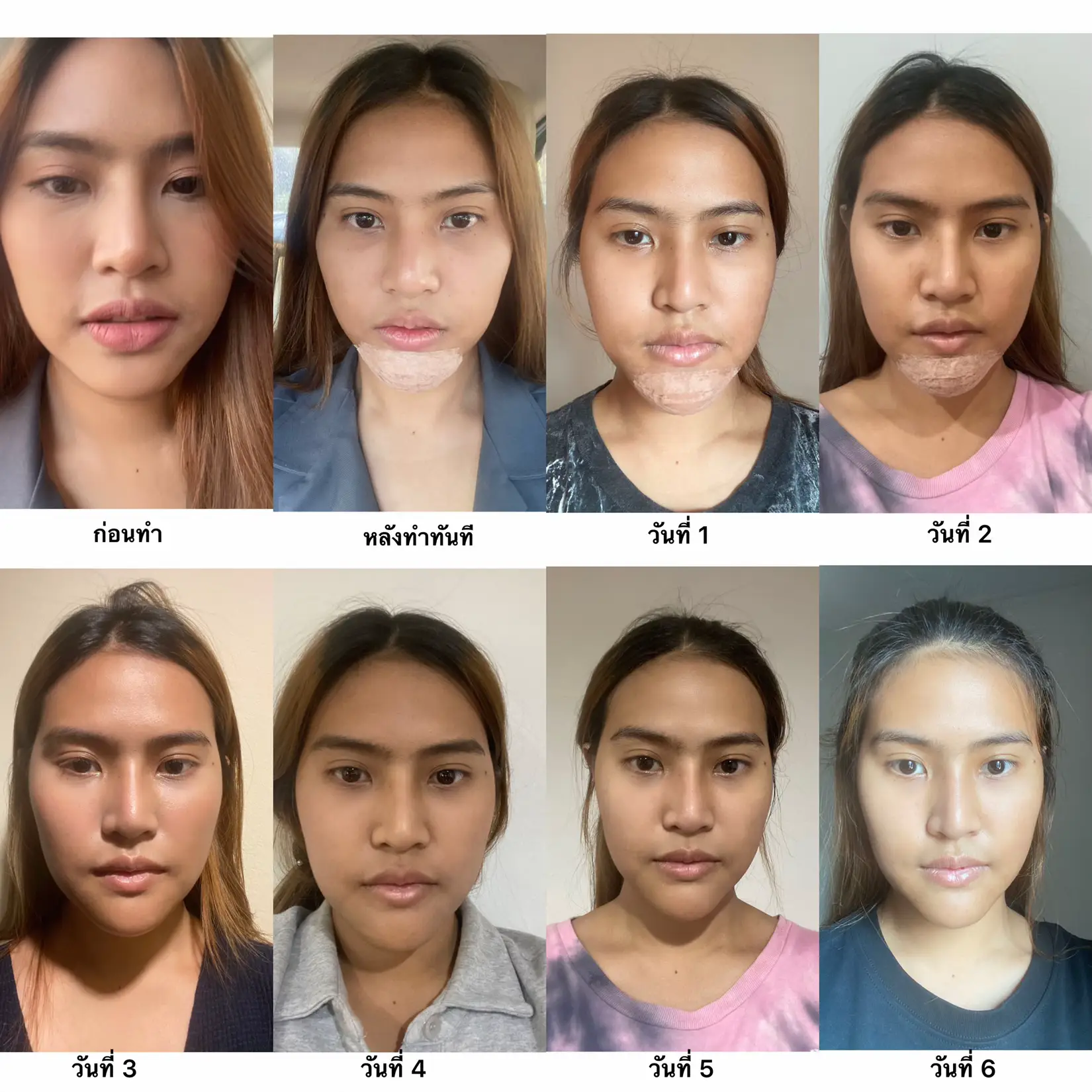 รีวิวแก้คางที่ Emma Cilnic ดีจริงหรือจกตา? | แกลเลอรีที่โพสต์โดย ...