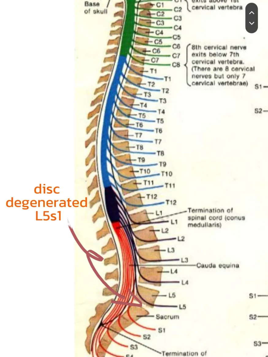 disc degenerated L5-S1 | แกลเลอรีที่โพสต์โดย Nich healthy | Lemon8