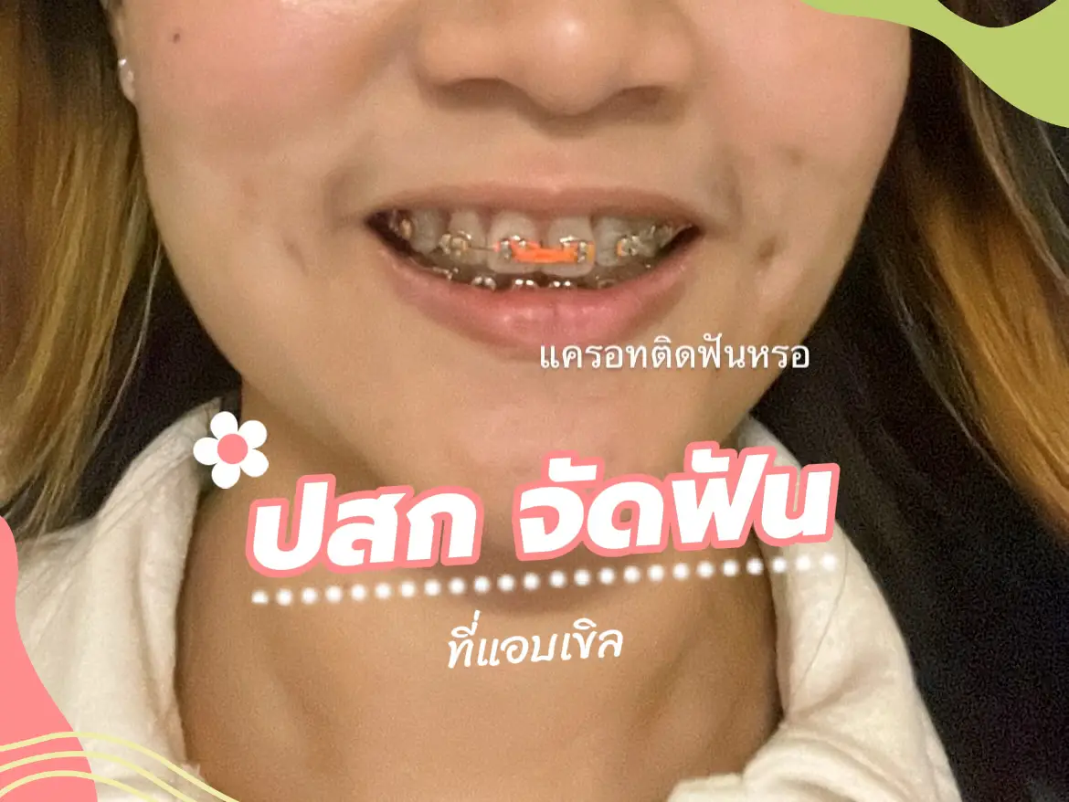 เล่าประสบการณ์จัดฟัน | แกลเลอรีที่โพสต์โดย Napjune Kyp | Lemon8