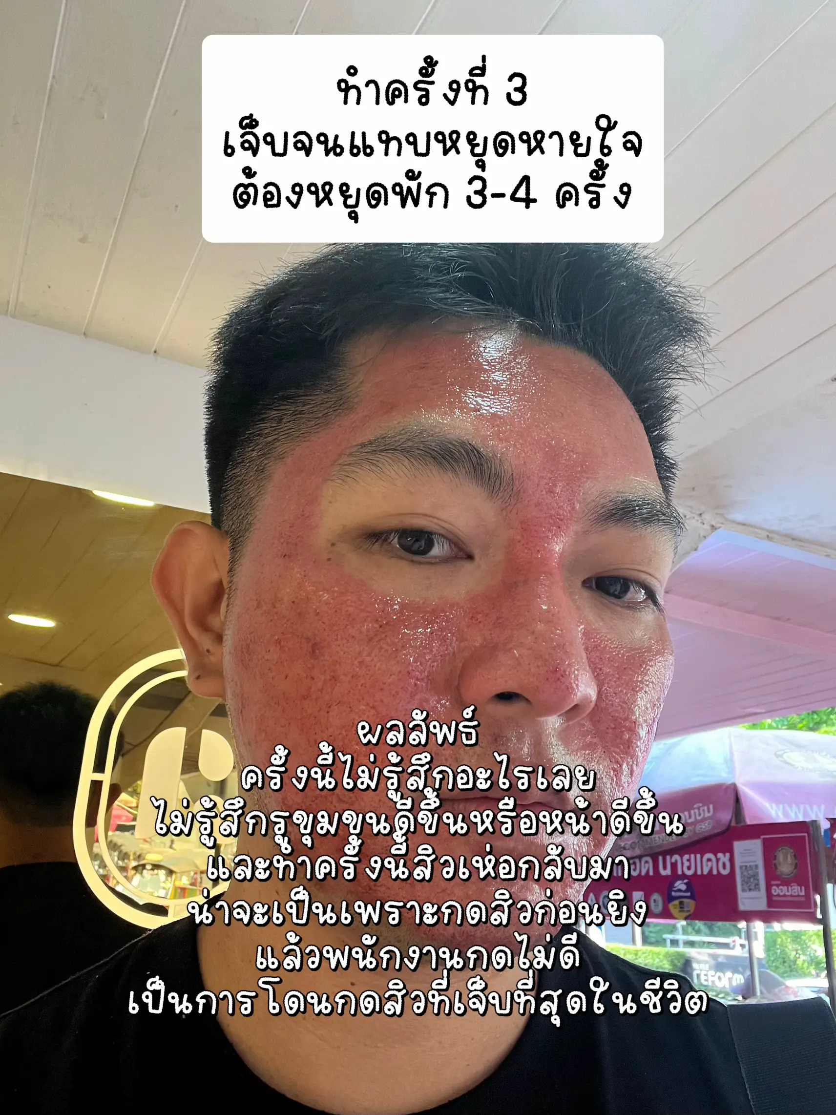 พลีชีพ ทำ PICO 6 ครั้ง แบบไม่มีอะไรเปลี่ยนเลย | แกลเลอรีที่โพสต์โดย Lec ...